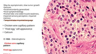 Primary brain tumors and their brief explanation | PPT