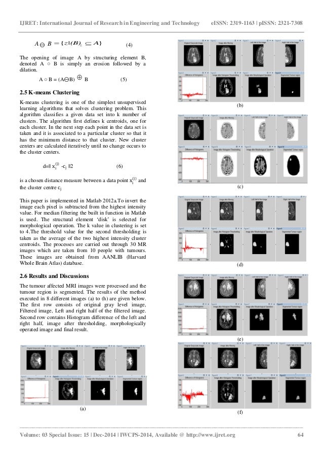 Brain Tumor Segmentation Using Asymmetry Based Histogram Thresholding