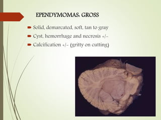 Brain tumors in children with Updates- Pranav | PPTX