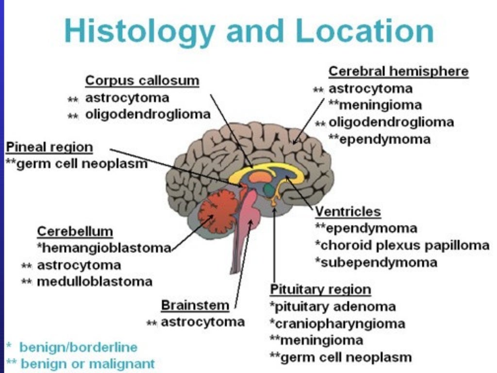 Brain tumors & Stem Cell Transplantation