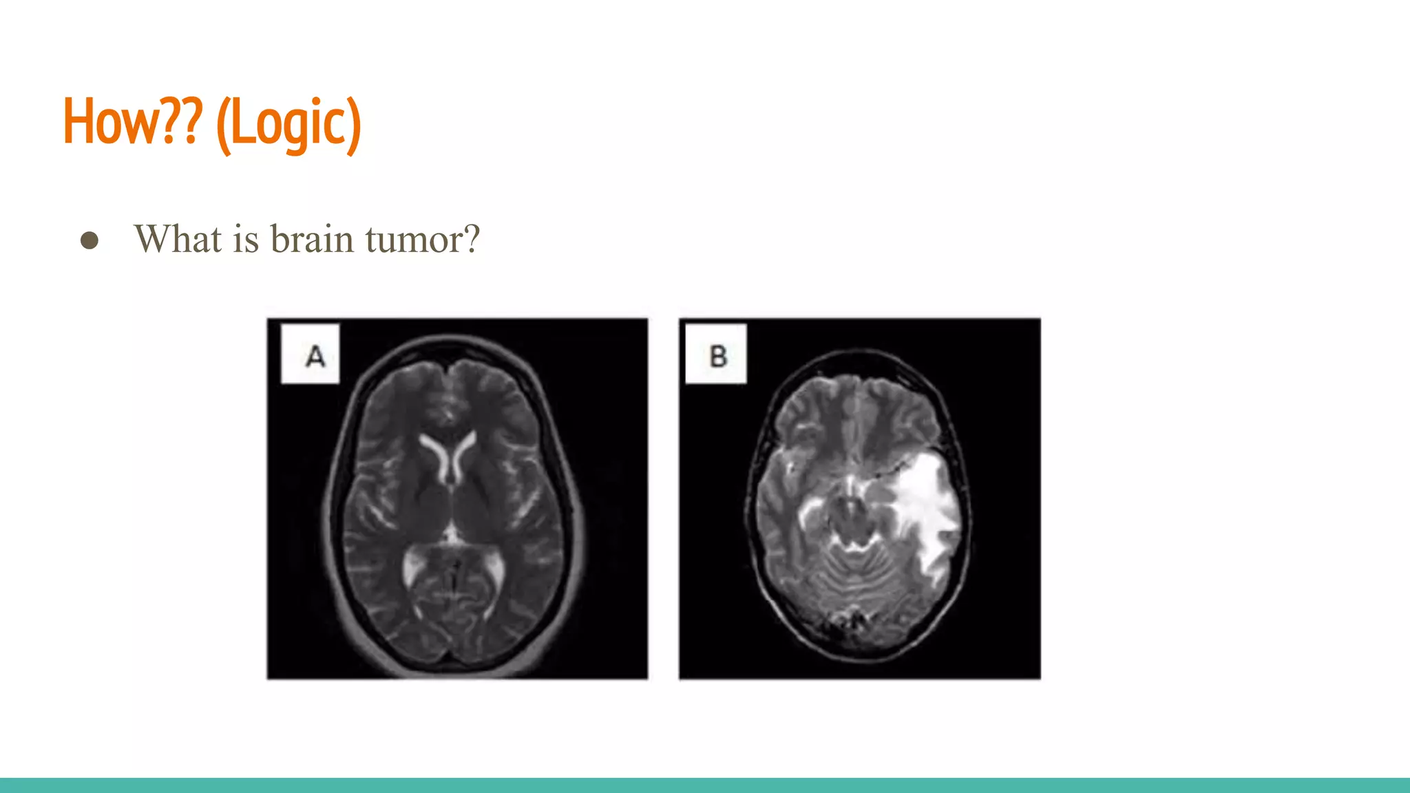 Brain Tumour Detection Pptx