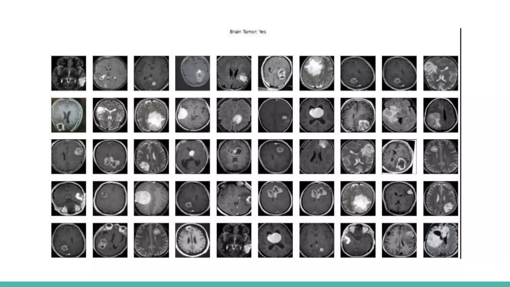 Brain Tumour Detection.pptx