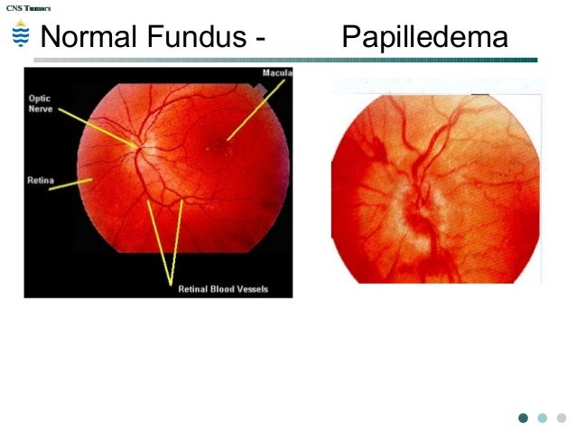 Papilledema Vs Normal