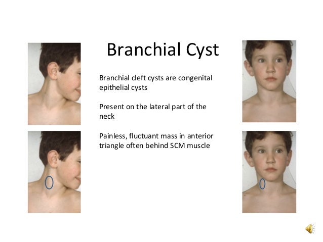 Skin Cyst Pictures Photos