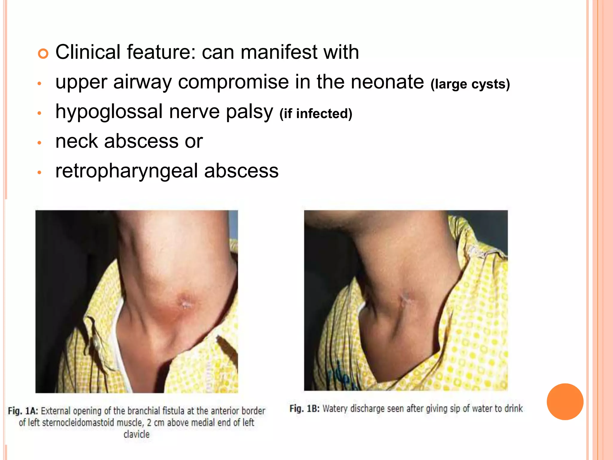 Branchial anomalies | PPTX