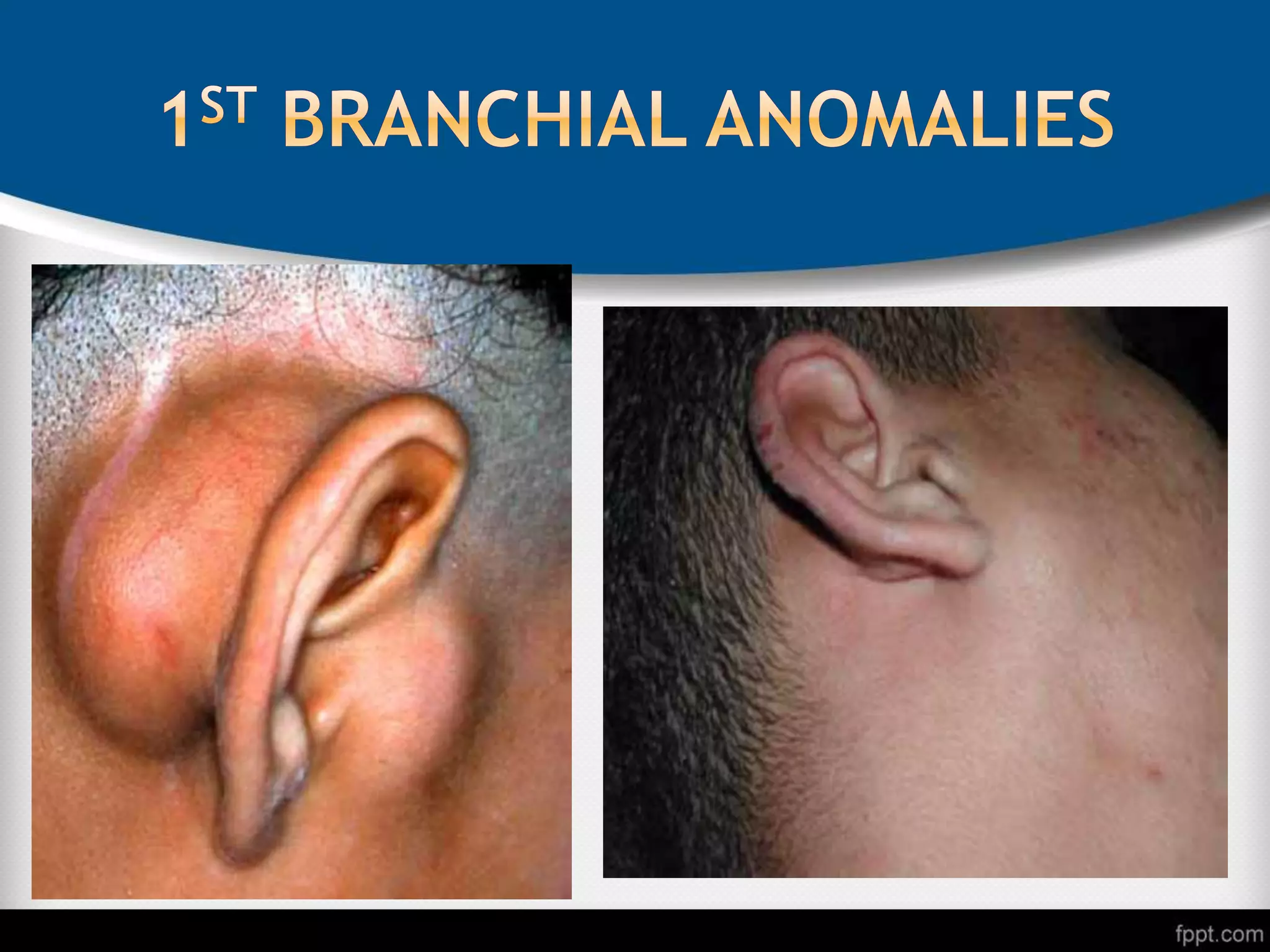 Branchial anomalies | PPTX