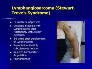 Br ca lines of surg treatment the lect | PPT