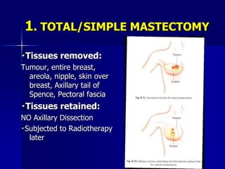 Br ca lines of surg treatment the lect | PPT