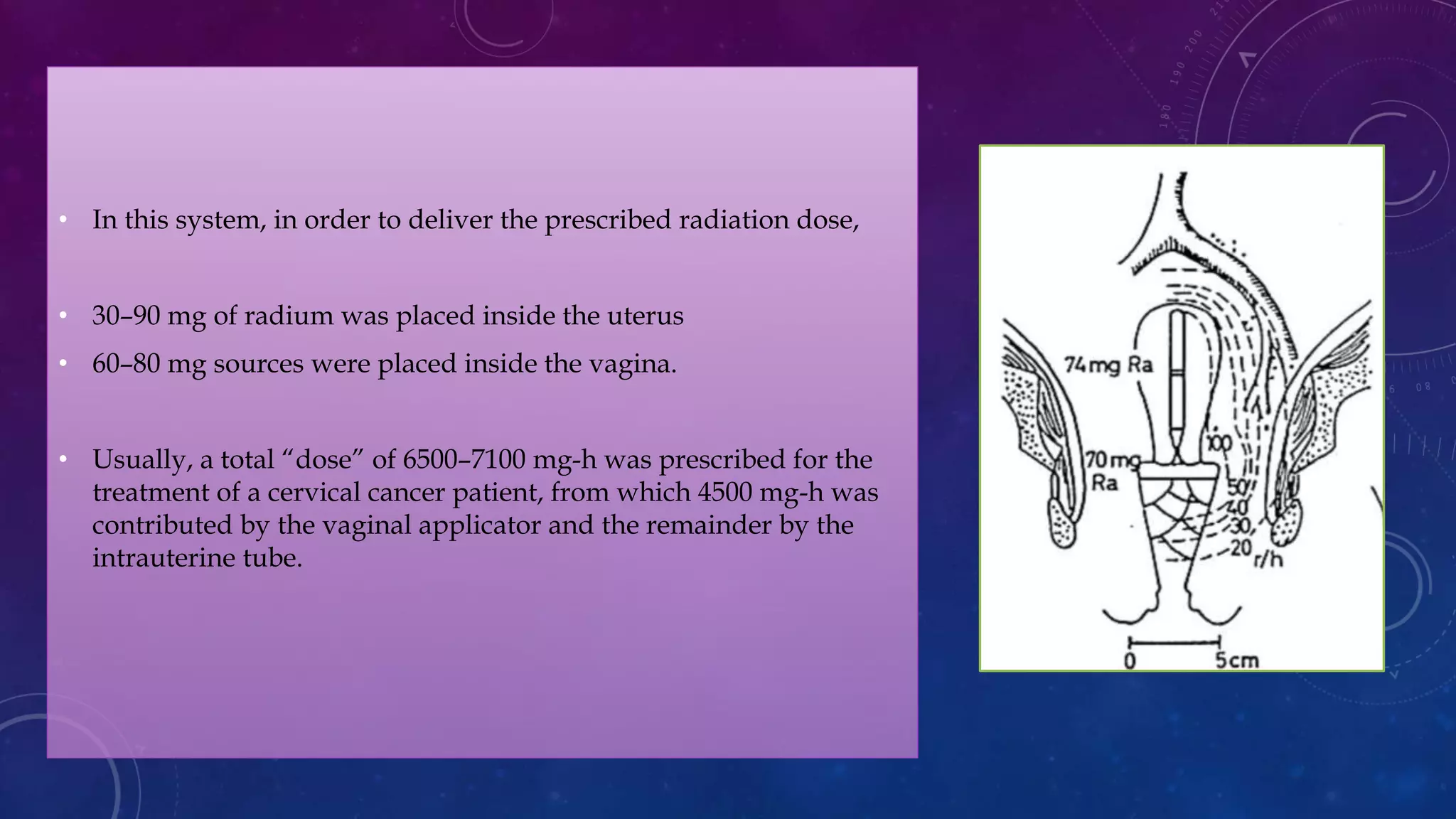Brachytherapy in Carcinoma Cervix | PDF