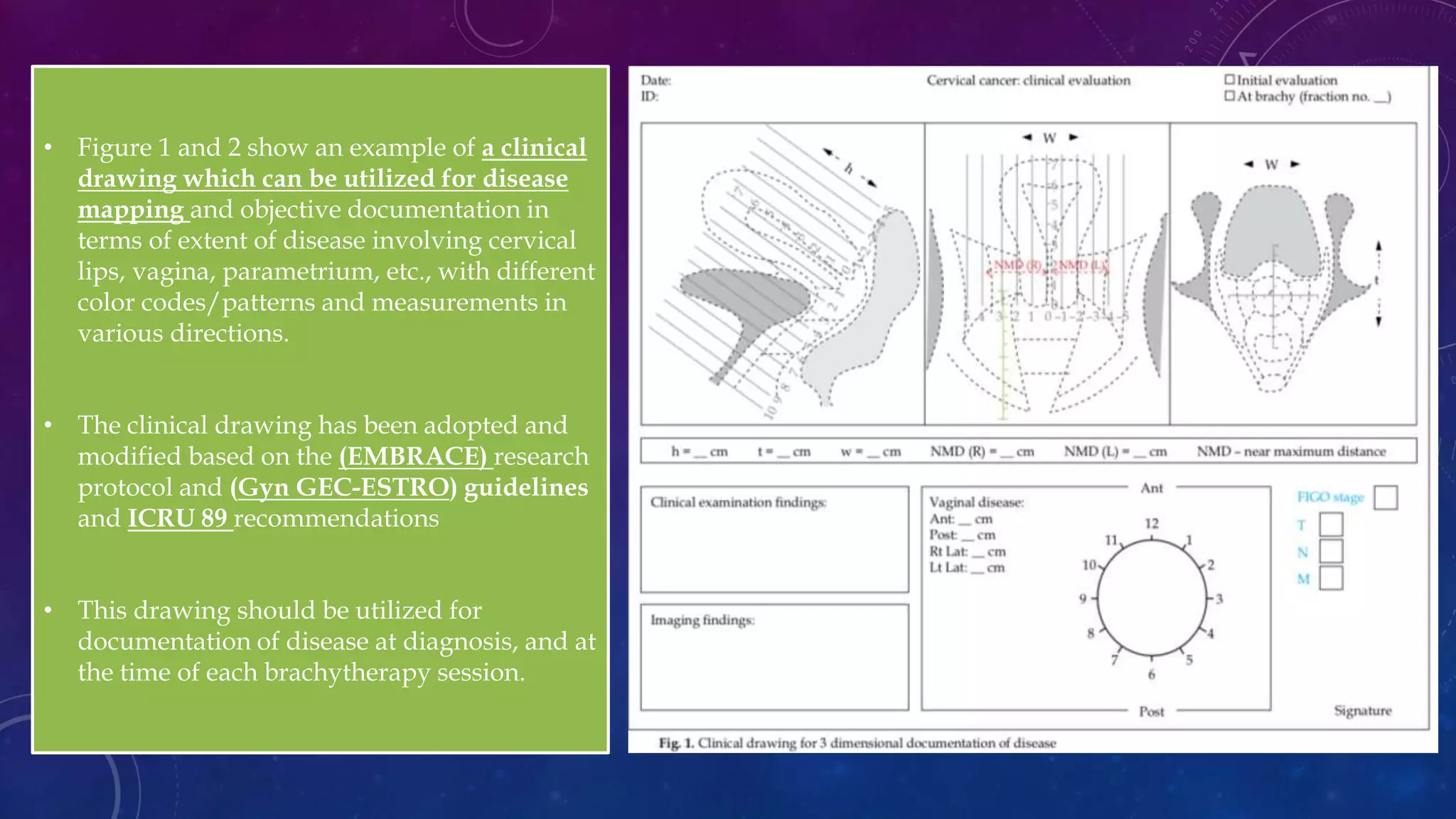 Brachytherapy in Carcinoma Cervix | PDF