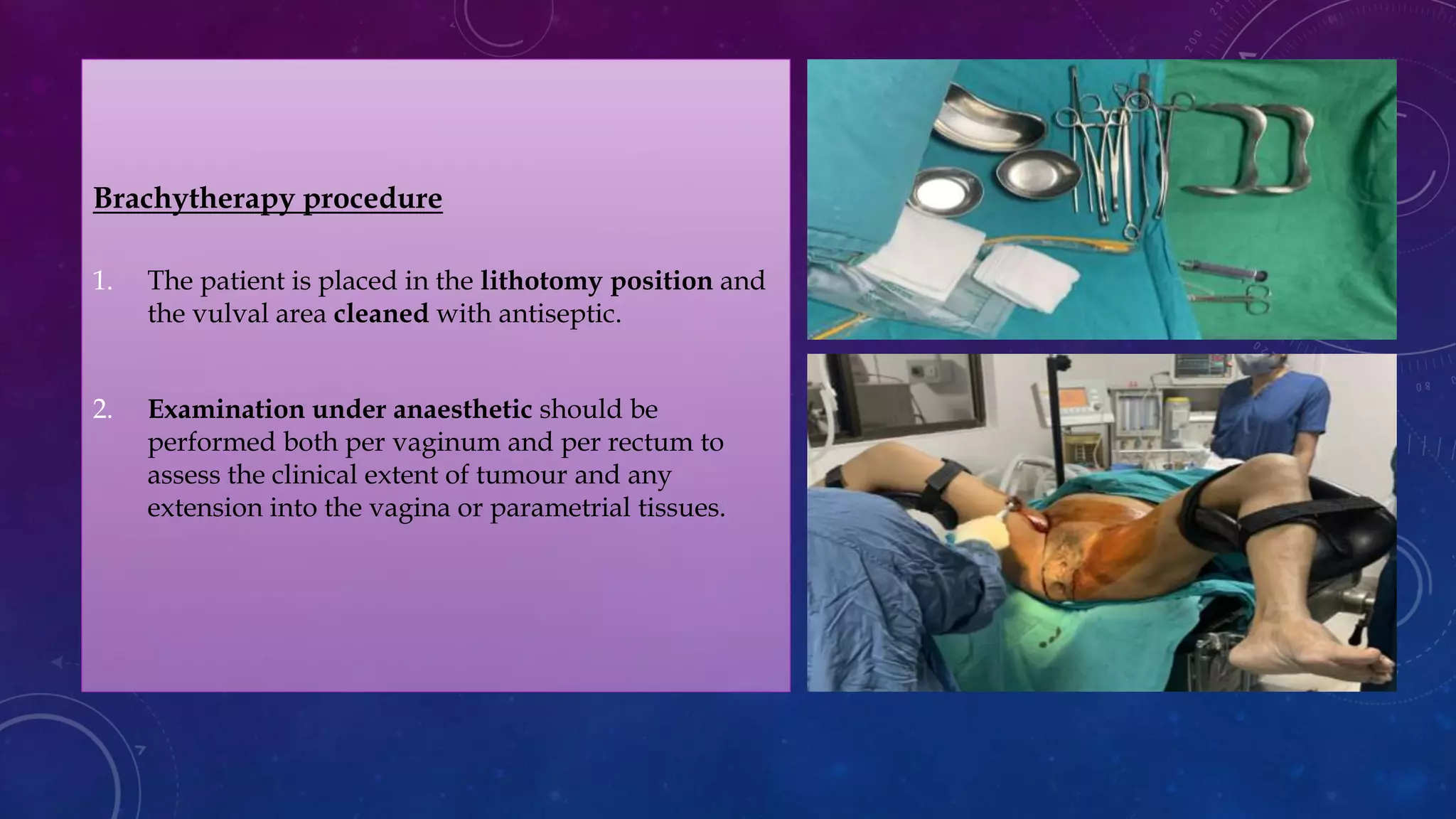 Brachytherapy in Carcinoma Cervix | PDF