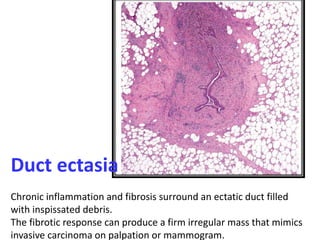 NON-NEOPLASTIC CONDITIONS OF BREAST | PPTX