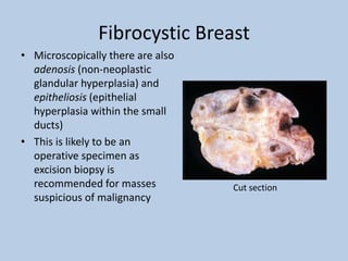 Breast.ppsx