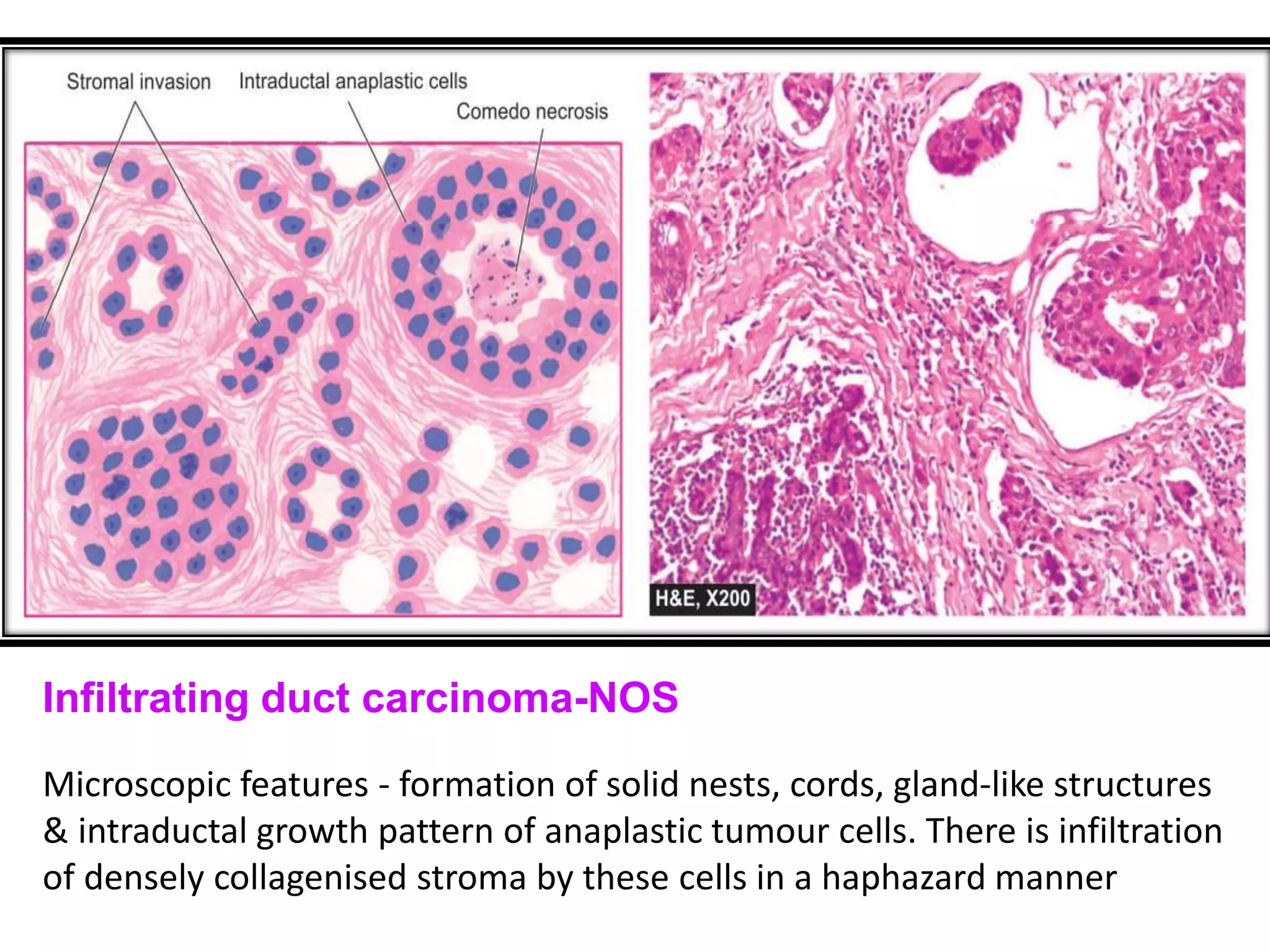 CARCINOMA OF THE BREAST | PPTX