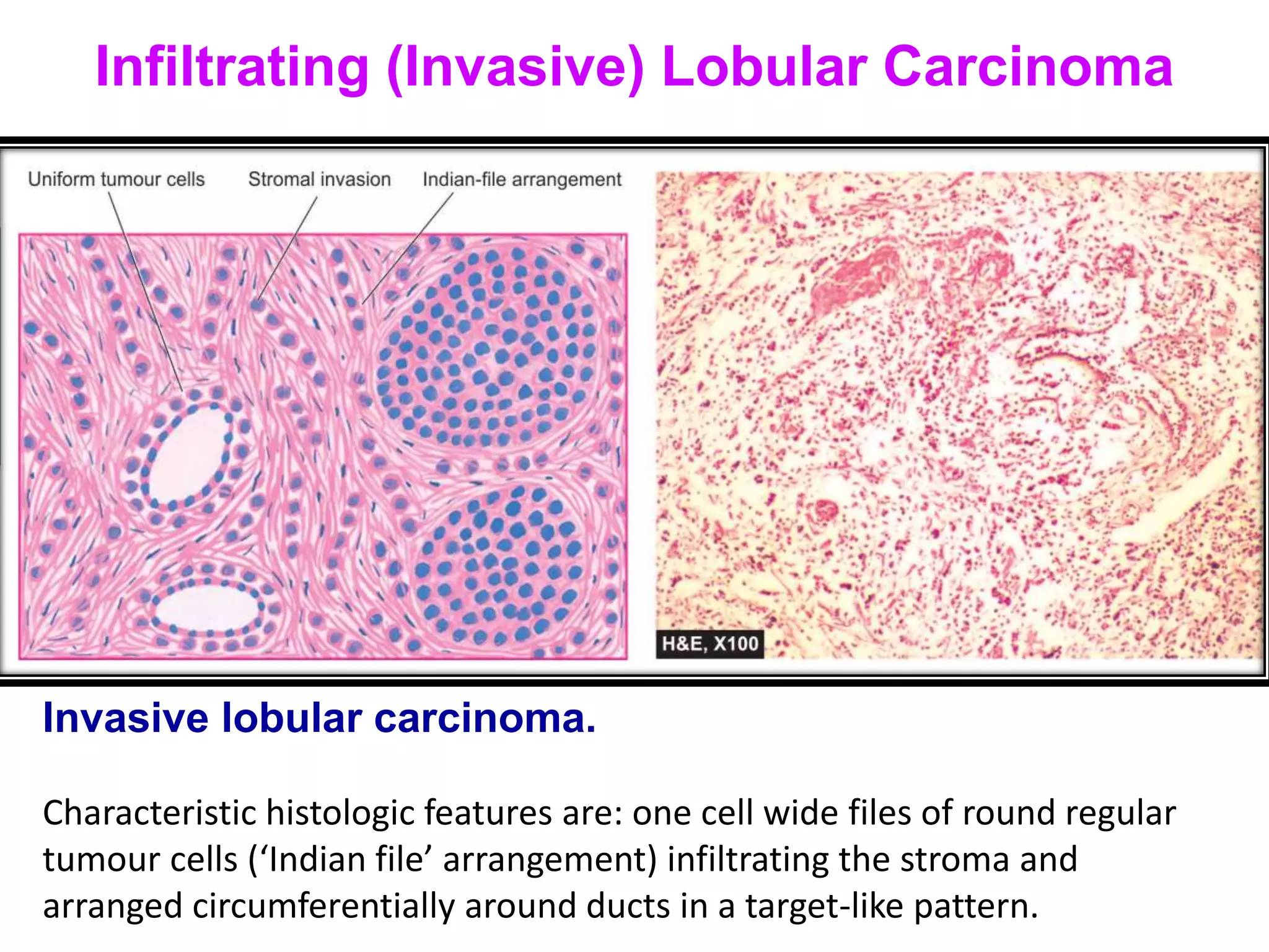 CARCINOMA OF THE BREAST | PPTX
