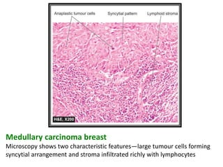 CARCINOMA OF THE BREAST | PPTX