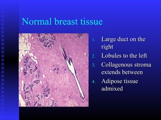 Breast cancer | PPT