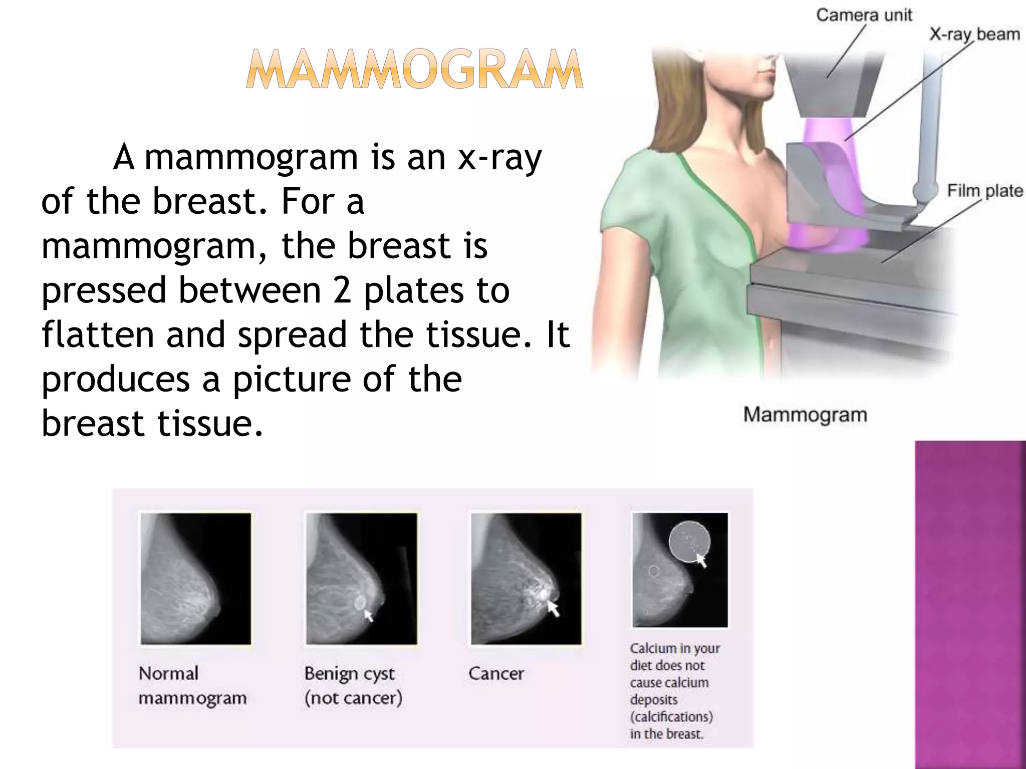 BREAST-CANCER-prevalence.pptx