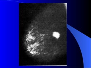 Breast Disease1 | PPT