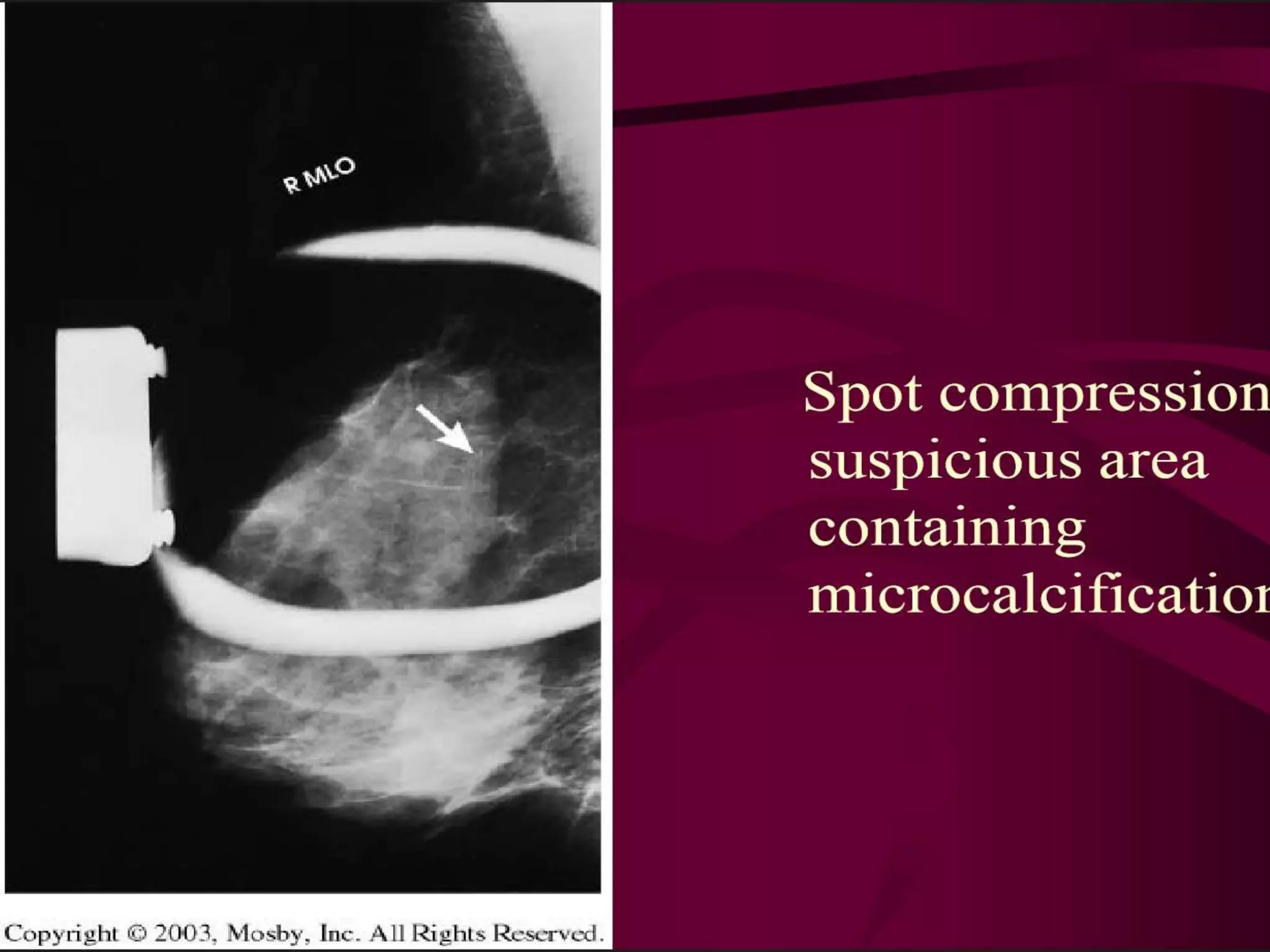 Breast imaging modalities | PPTX