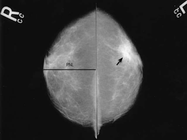 Breast imaging modalities | PPTX