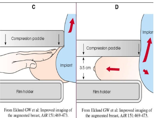 Breast imaging modalities | PPTX