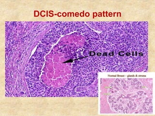 Breast malignant lesions-in situ lesions- MBBS | PPT