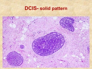 Breast malignant lesions-in situ lesions- MBBS | PPT