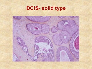 Breast malignant lesions-in situ lesions- MBBS | PPT