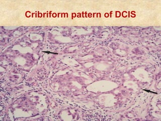 Breast malignant lesions-in situ lesions- MBBS | PPT