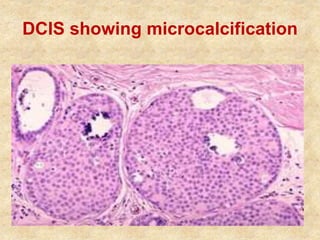 Breast malignant lesions-in situ lesions- MBBS | PPT