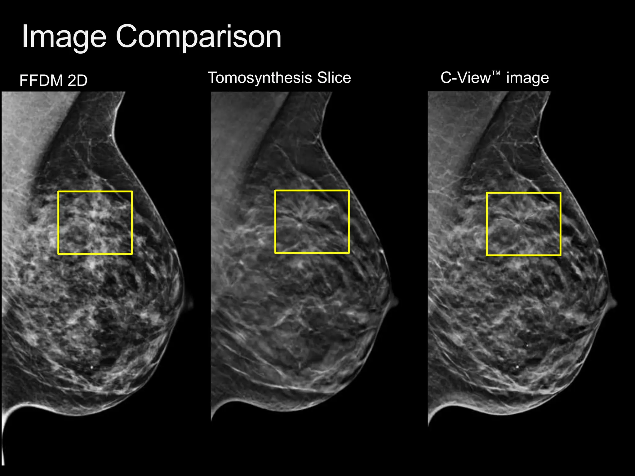 Breast-Tomosynthesis-for-MDs-PPT.pptx