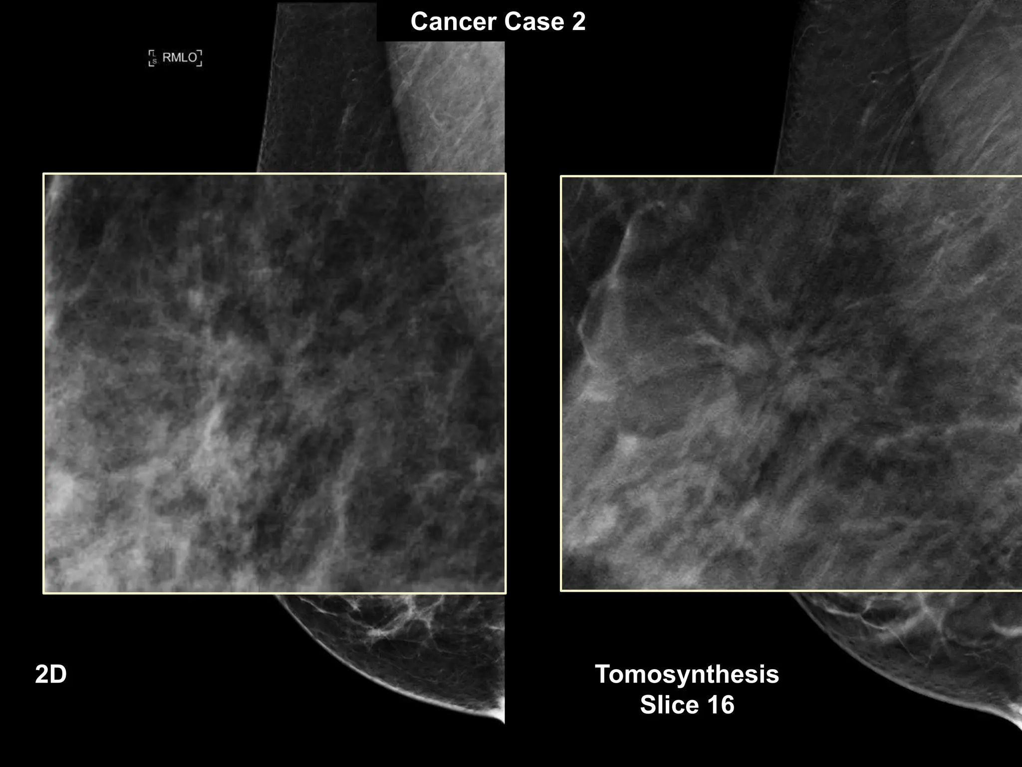 Breast-Tomosynthesis-for-MDs-PPT.pptx