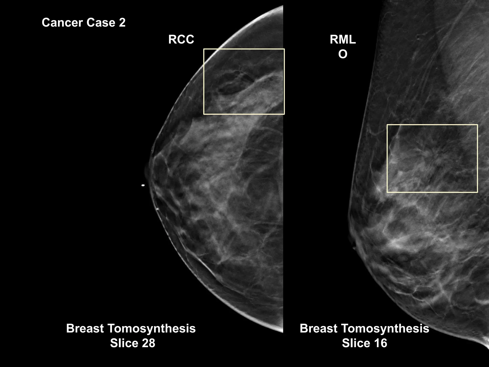 Breast-Tomosynthesis-for-MDs-PPT.pptx