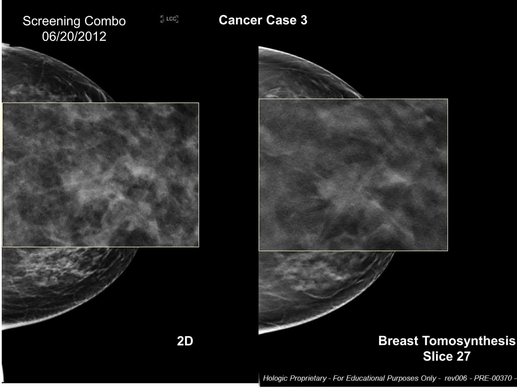 Breast-Tomosynthesis-for-MDs-PPT.pptx