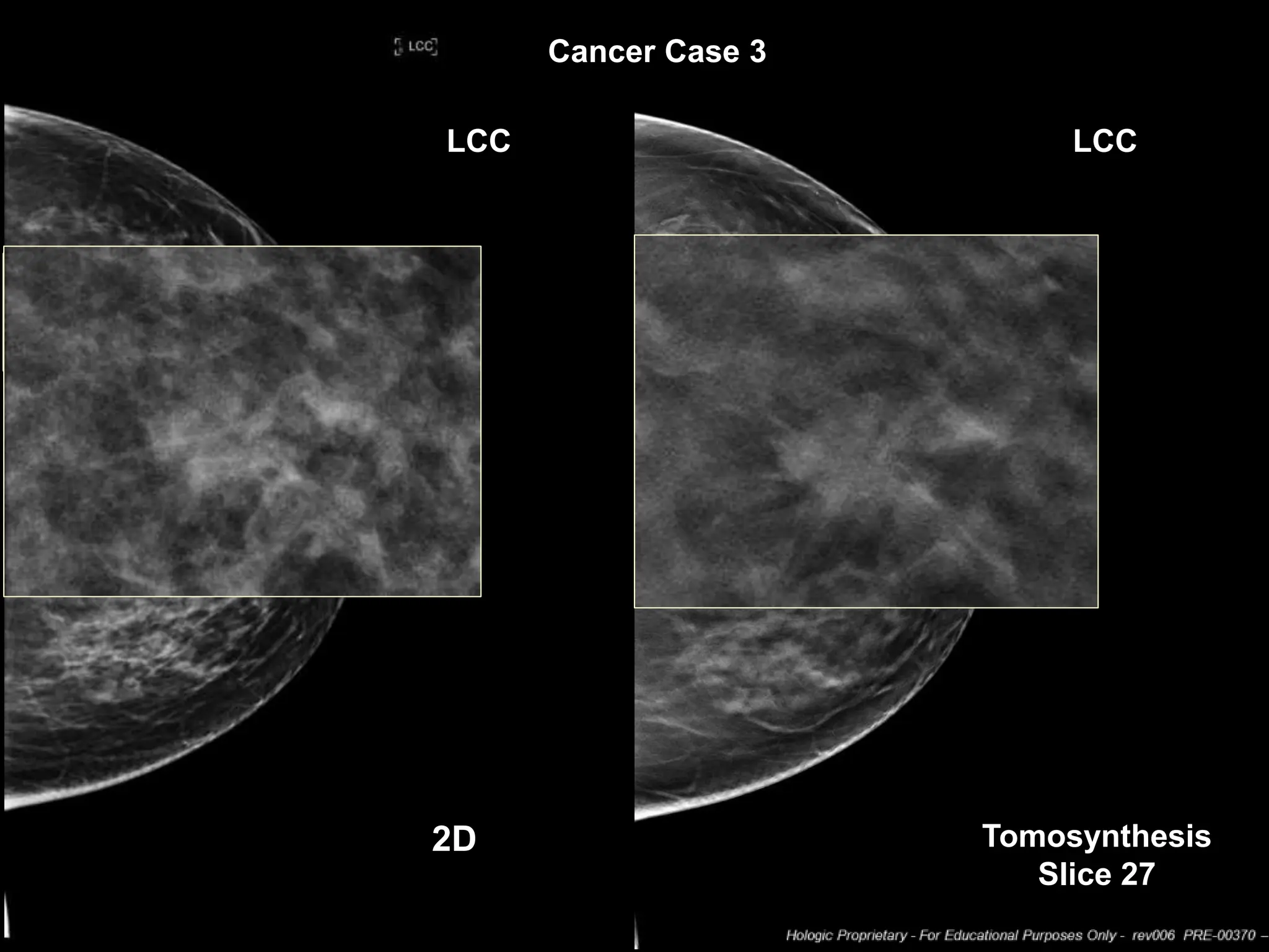 Breast-Tomosynthesis-for-MDs-PPT.pptx