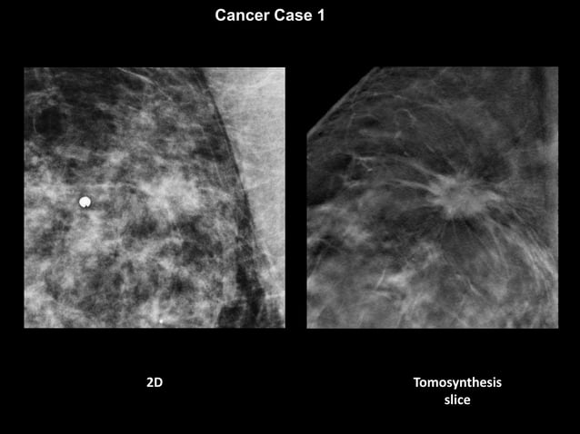Breast-Tomosynthesis-for-MDs-PPT.pptx