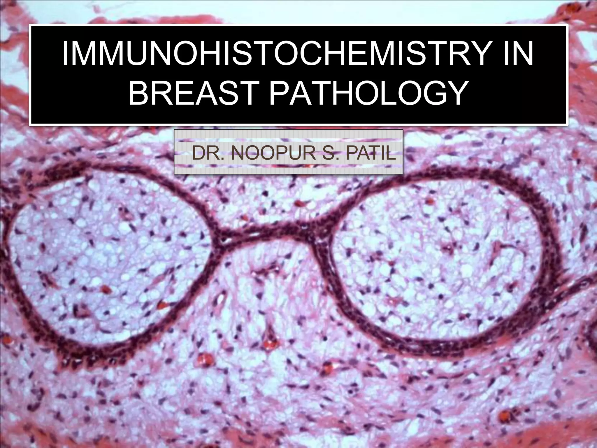 Immunohistochemistry of breast lesions(IHC) | PPTX