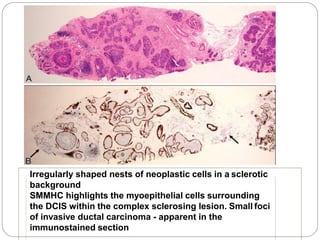 Immunohistochemistry of breast lesions(IHC) | PPTX