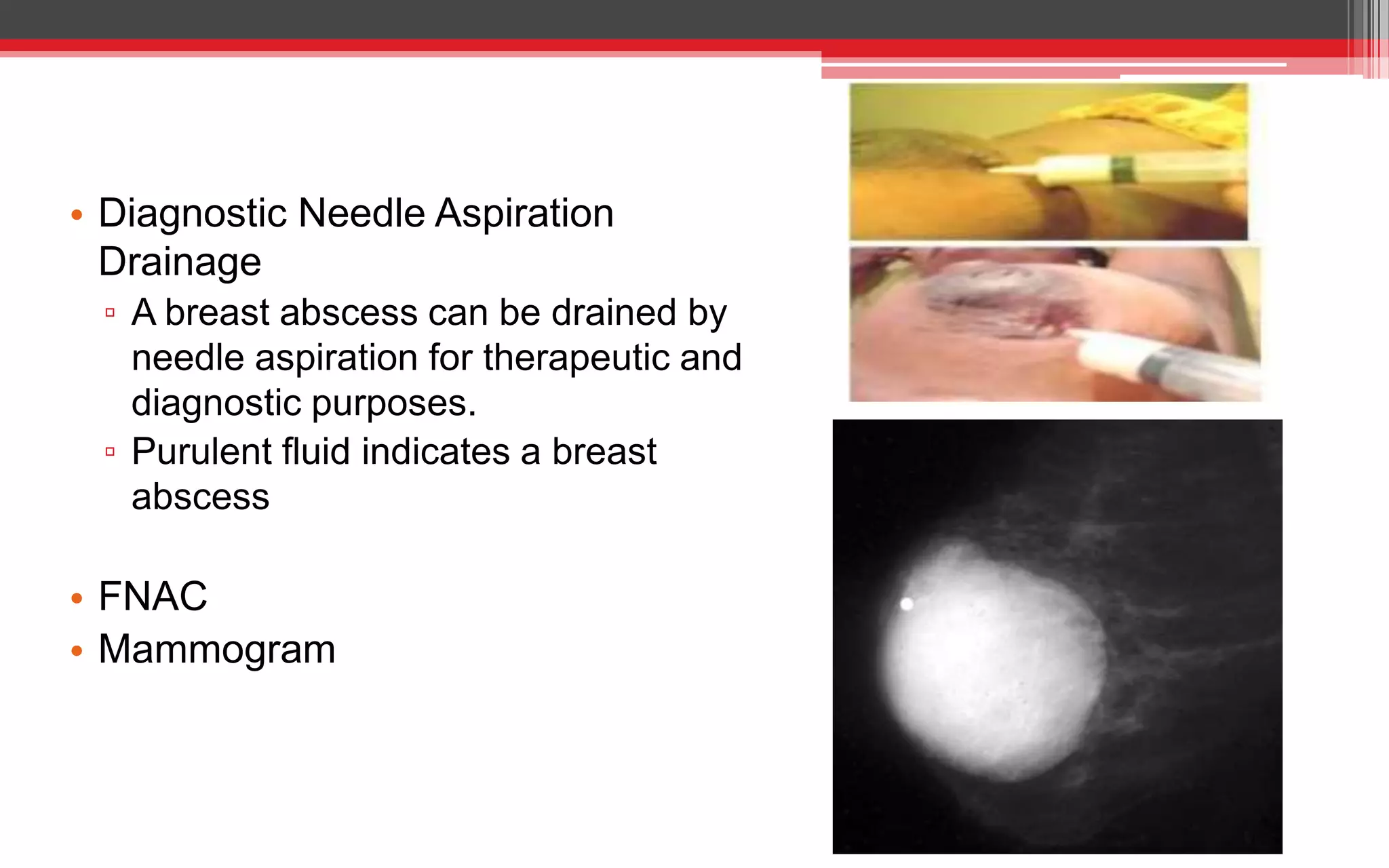 Breast Abscess | PPTX