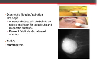 Breast Abscess | PPTX