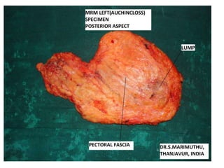 Breast Operative Anatomy by Dr Marimuthu Thanjavur | PPT