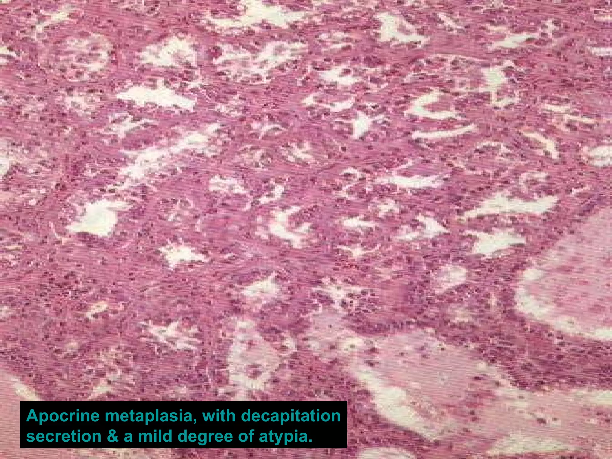Breast Atypical Lesions | PPT