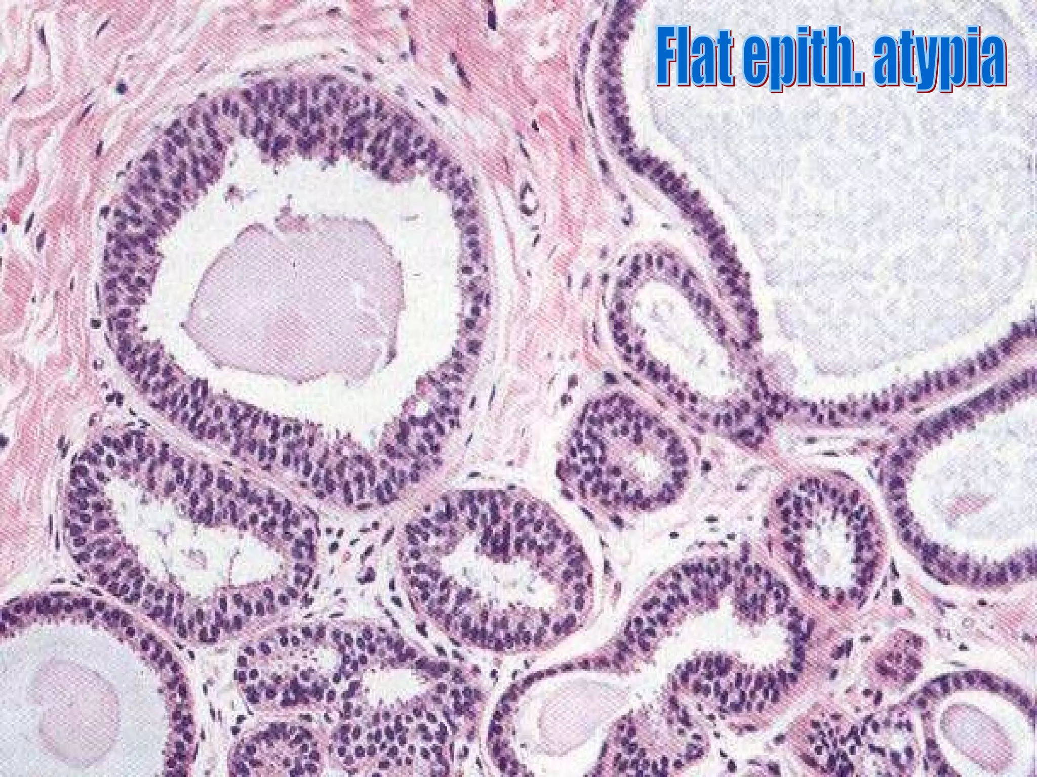 Breast Atypical Lesions | PPT