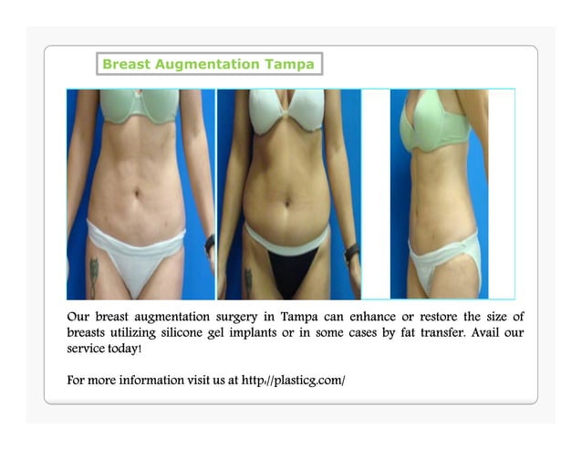 Breast augmentation tampa | PDF