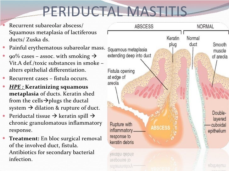 Breast benign disorders pathology