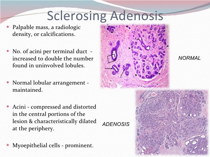 Breast benign disorders pathology