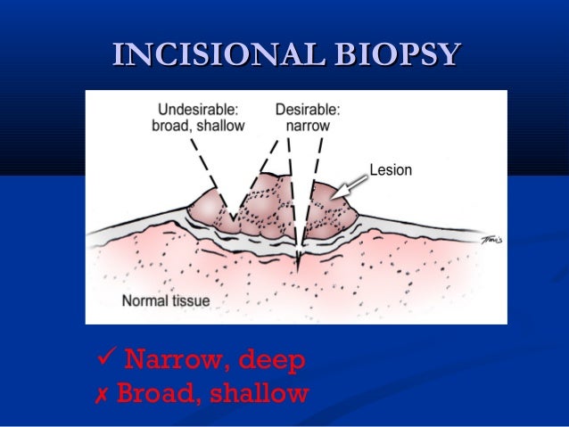 Breast biopsy ppt
