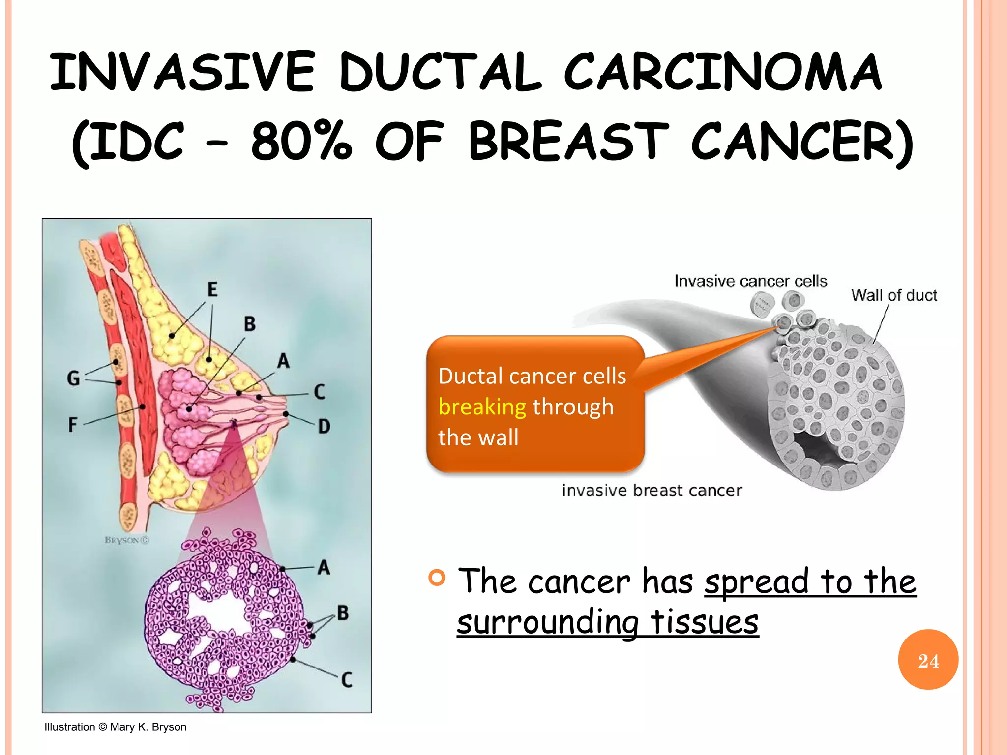 Breast CA by Dr. Celine Tey | PPT