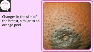 Breast ca awareness month | PPTX